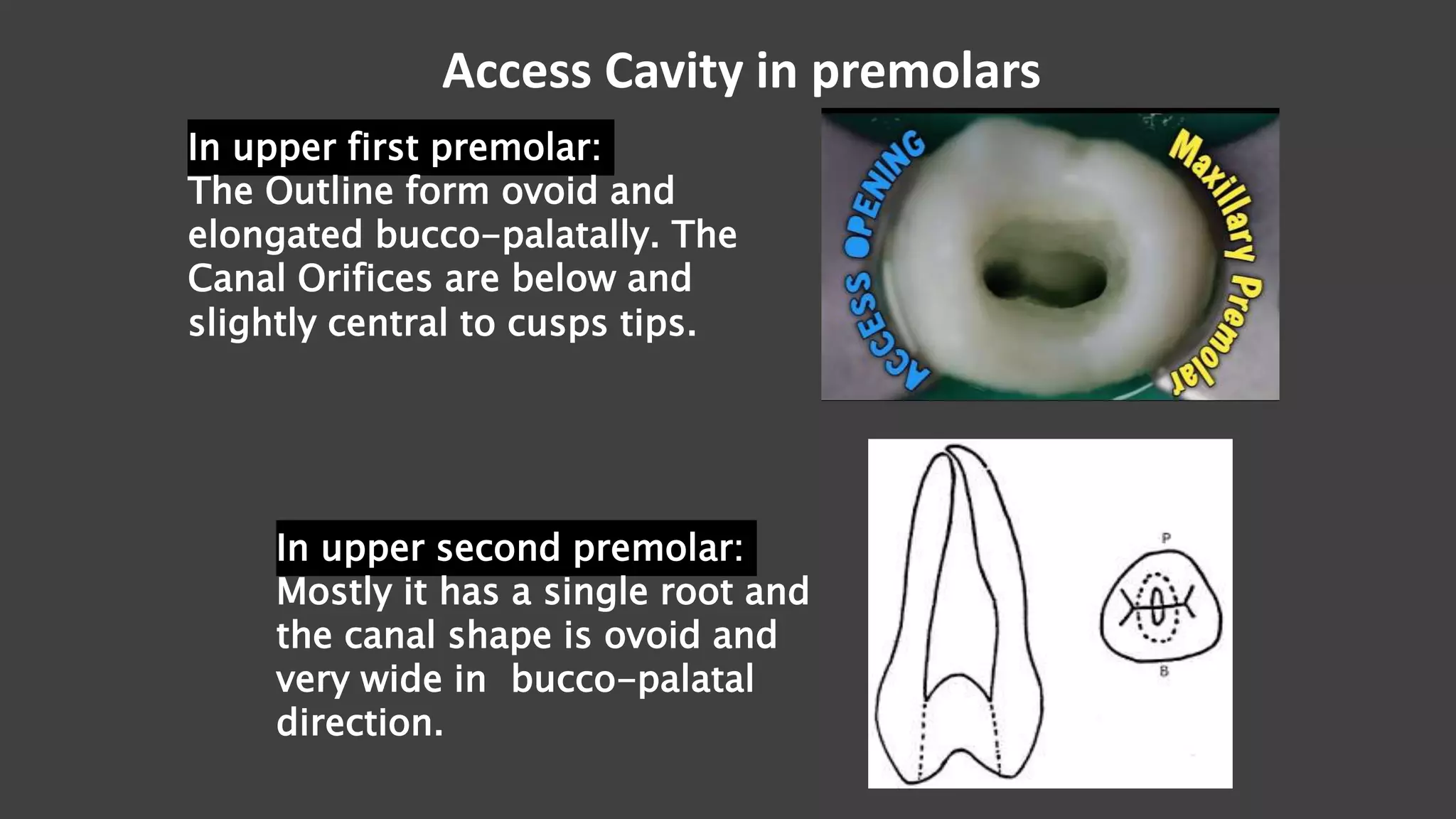 Endodontic access cavity for anterior teeth Dr. Ali Mohammed | PPTX