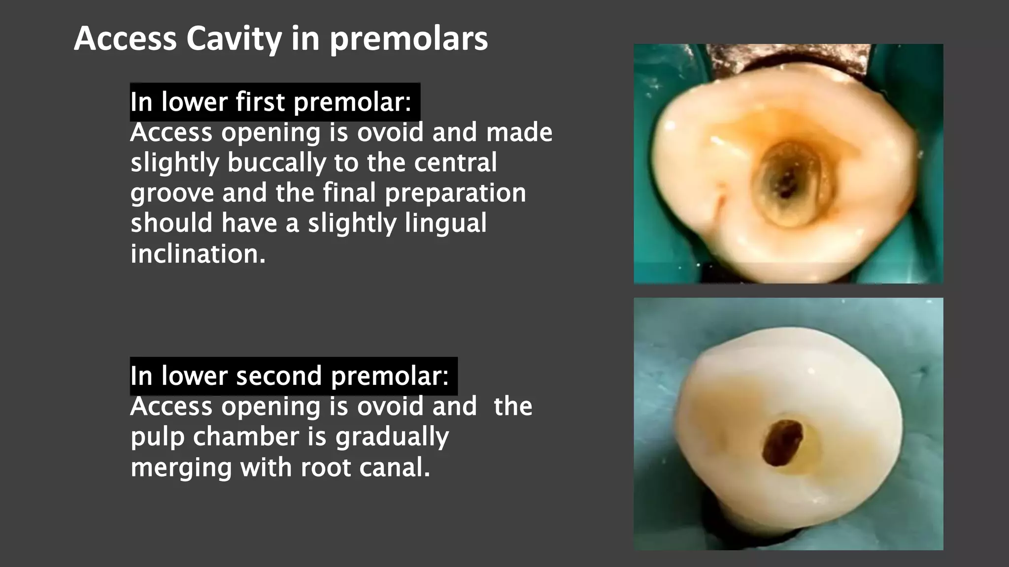Endodontic access cavity for anterior teeth Dr. Ali Mohammed | PPTX