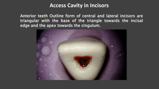 Endodontic access cavity for anterior teeth Dr. Ali Mohammed | PPTX