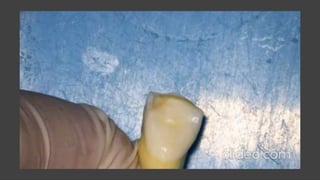 Endodontic access cavity for anterior teeth Dr. Ali Mohammed | PPTX