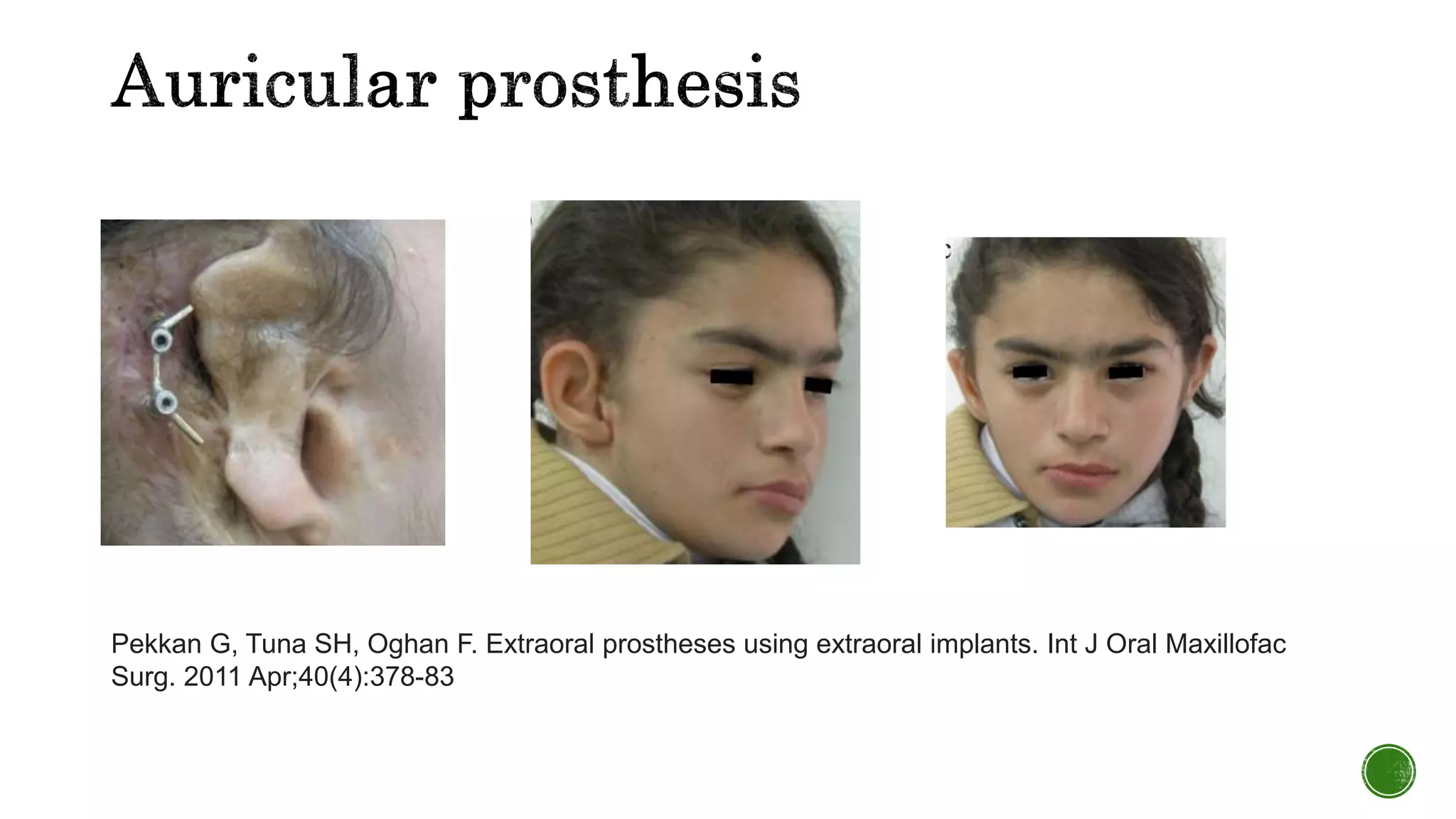 Endosseous implants in maxillofacial prosthesis.pptx