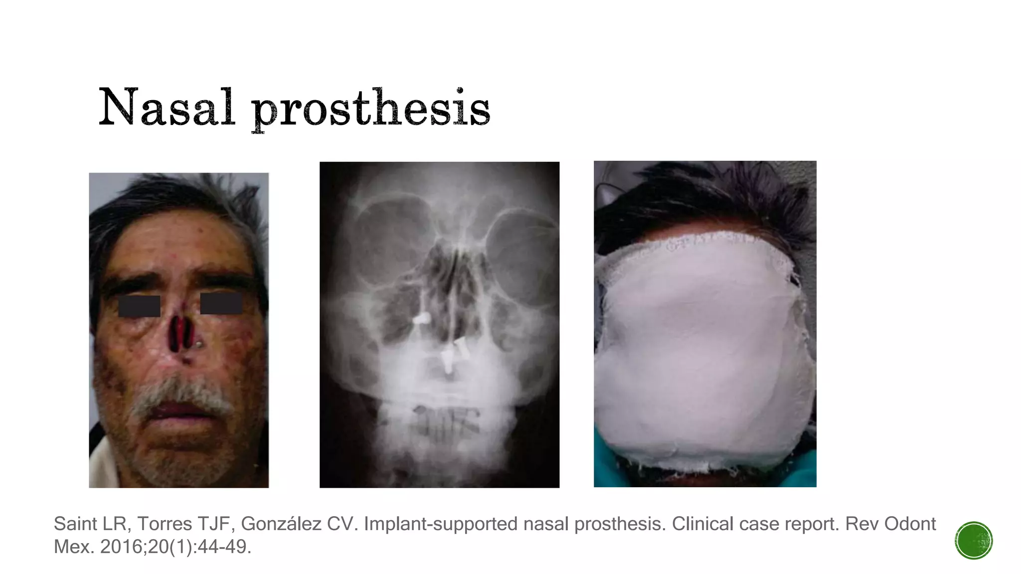 Endosseous implants in maxillofacial prosthesis.pptx