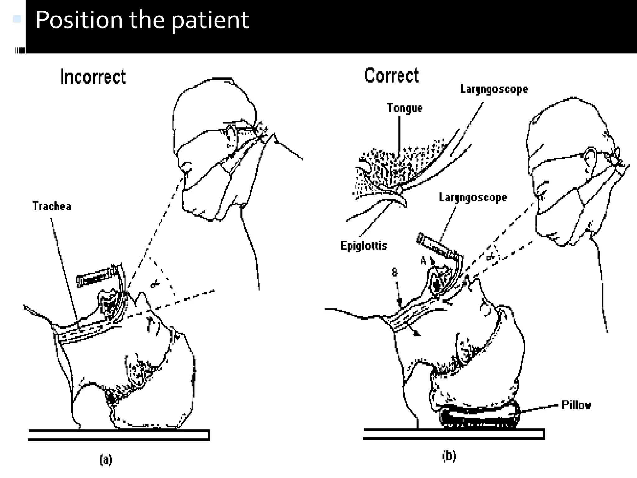 Endotracheal intubation | PPTX