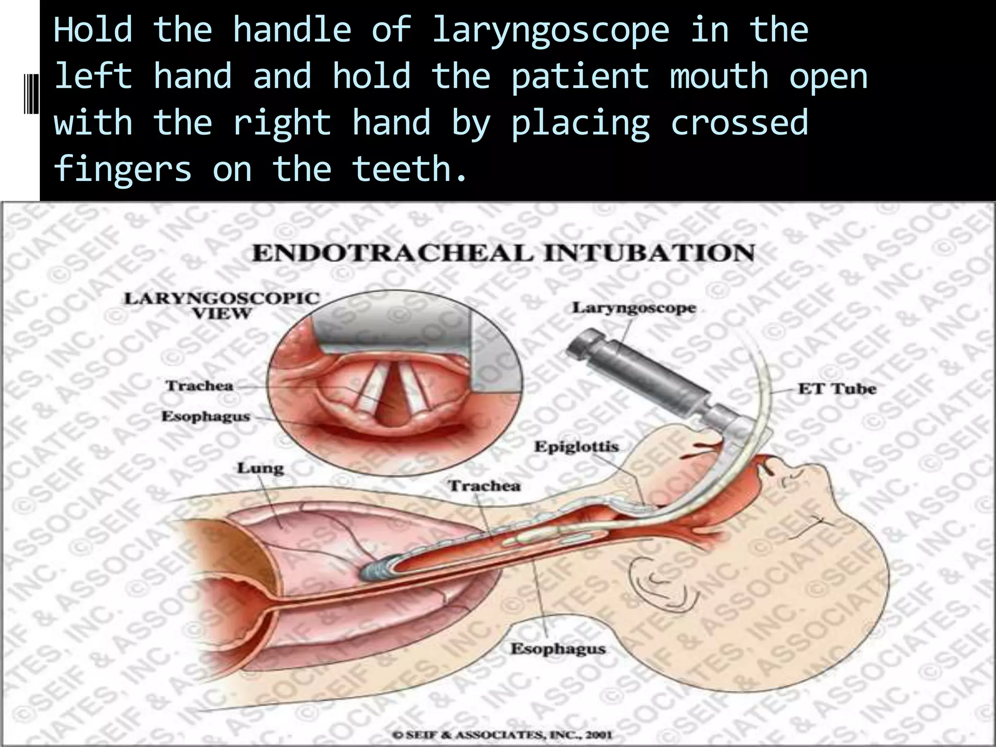 Endotracheal intubation | PPT