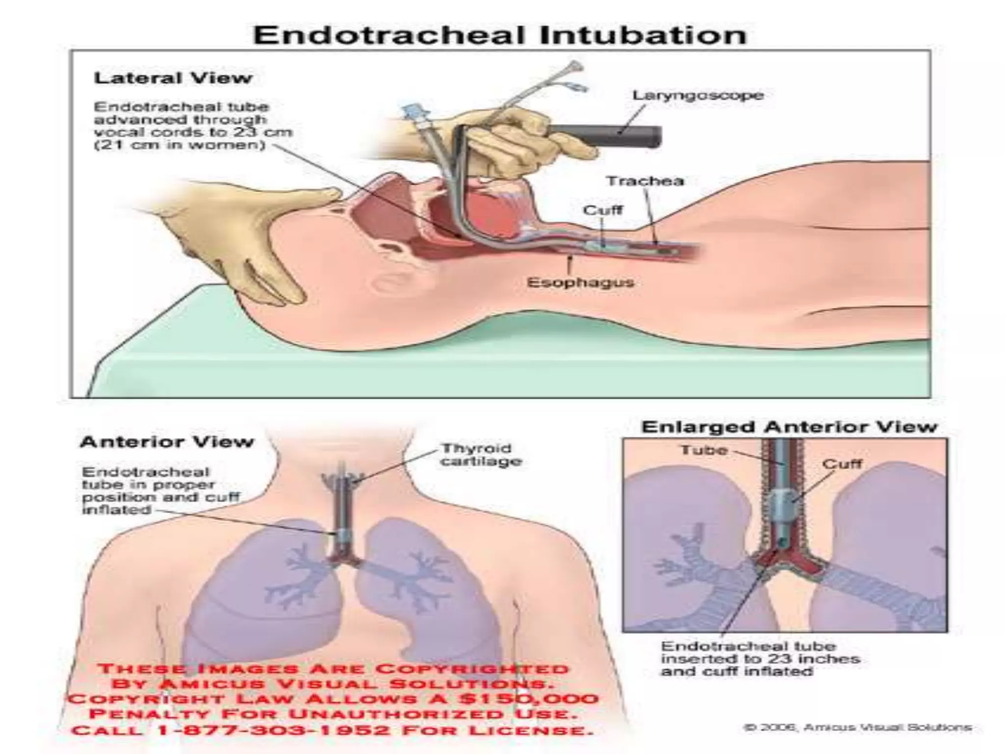Endotracheal intubation | PPTX