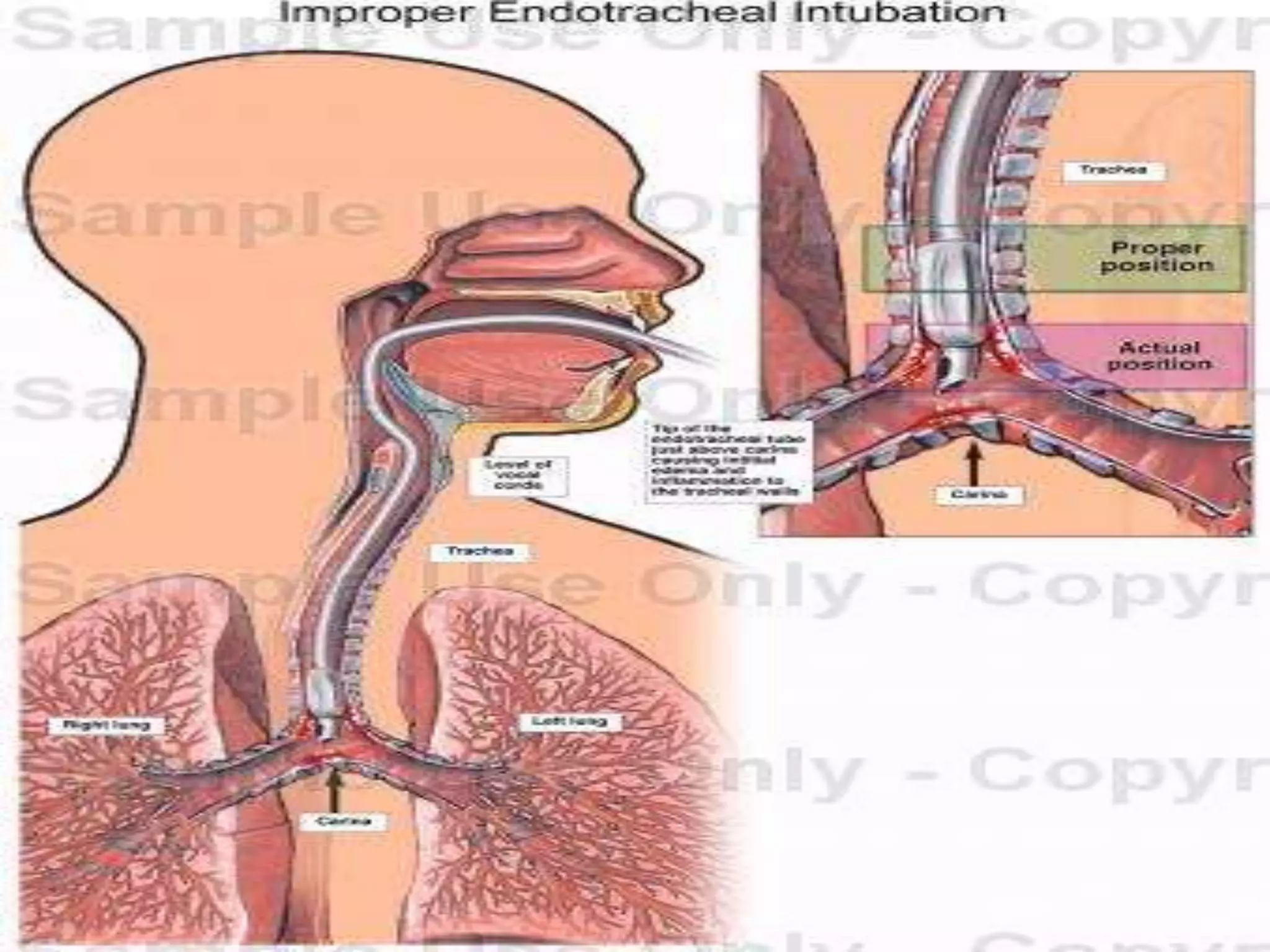 Endotracheal intubation | PPTX