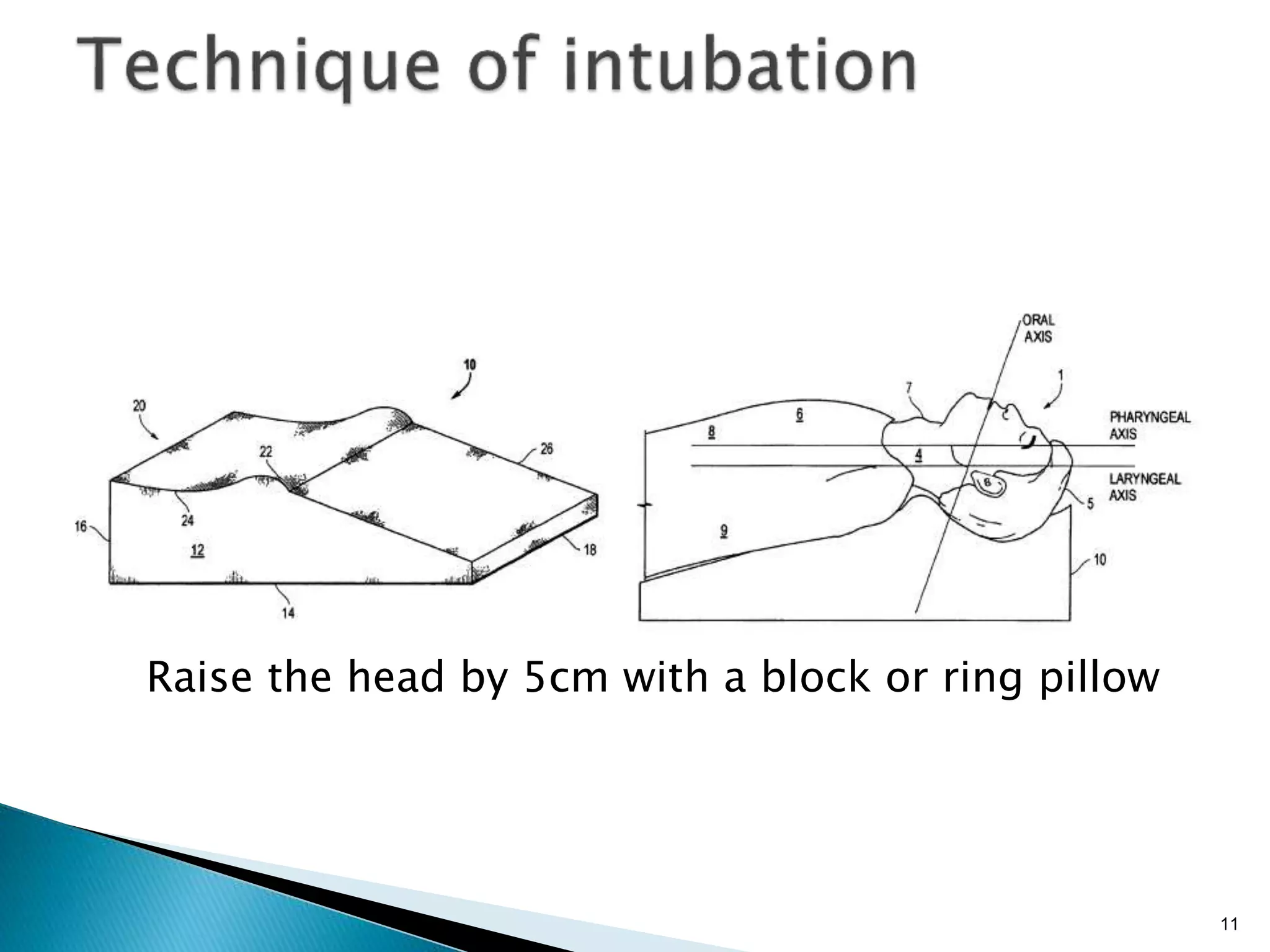 Endotracheal intubation | PPTX