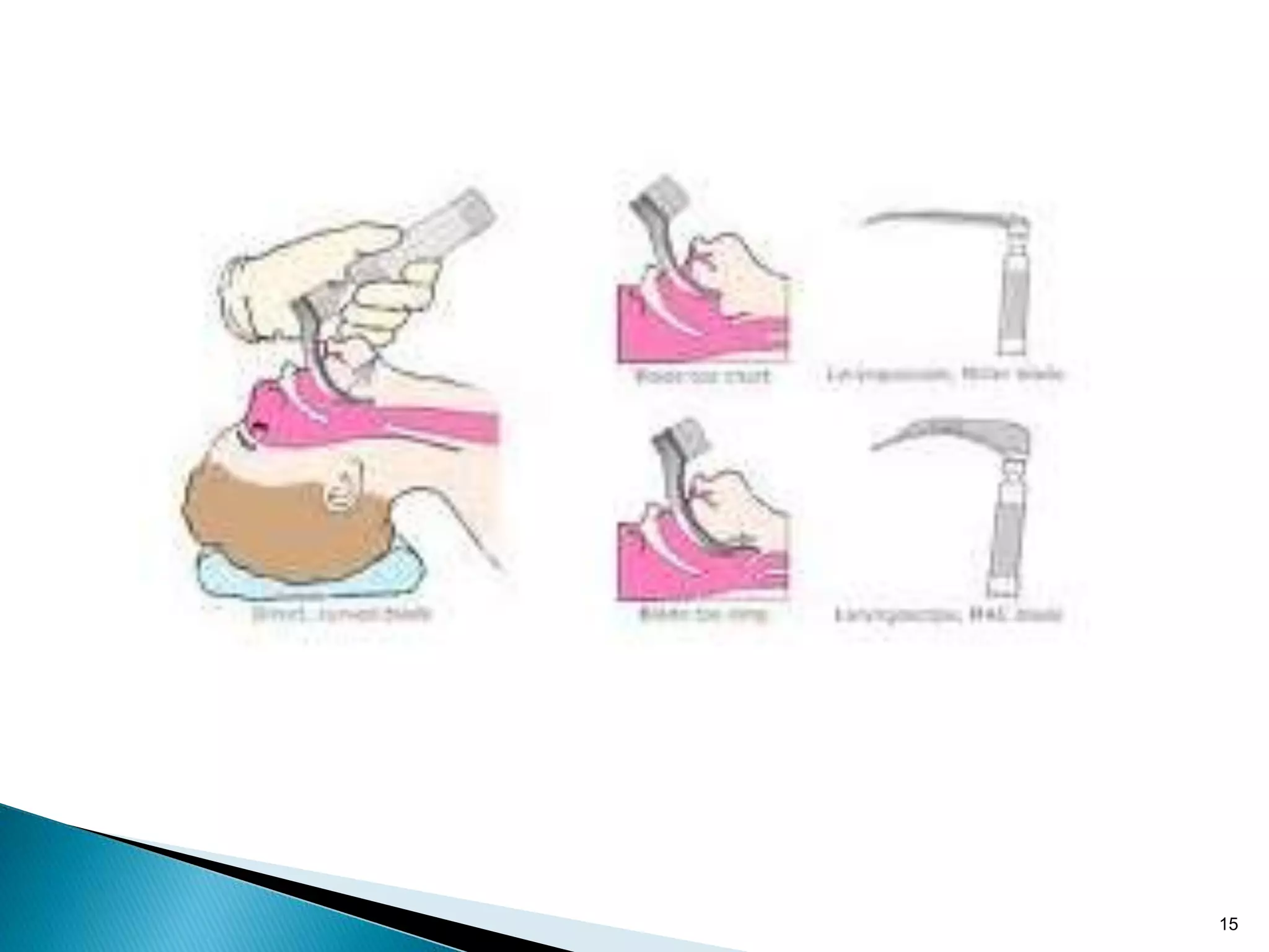 Endotracheal intubation | PPTX
