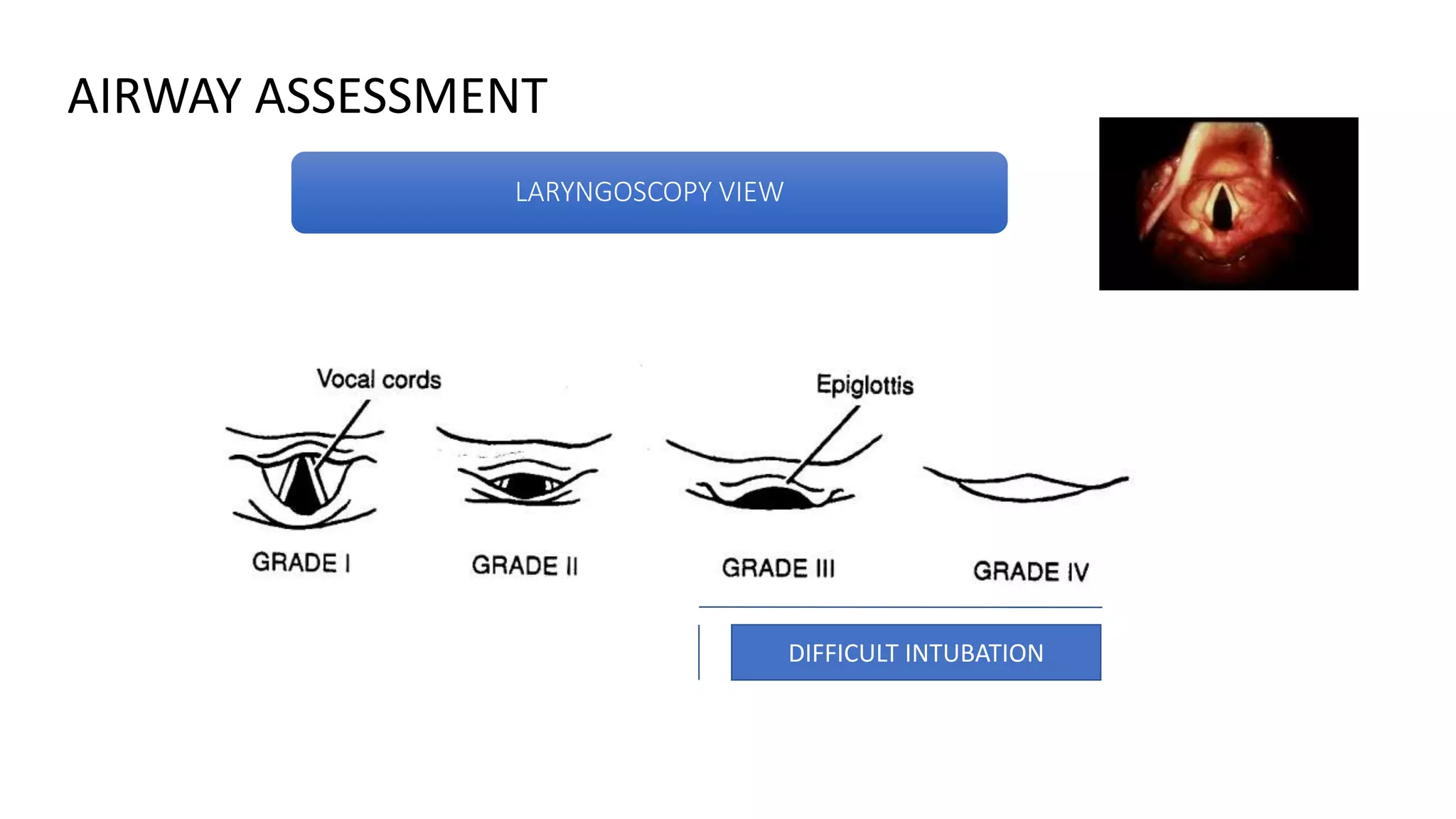 Endotracheal intubation | PPTX | Ear, Nose and Throat Conditions ...