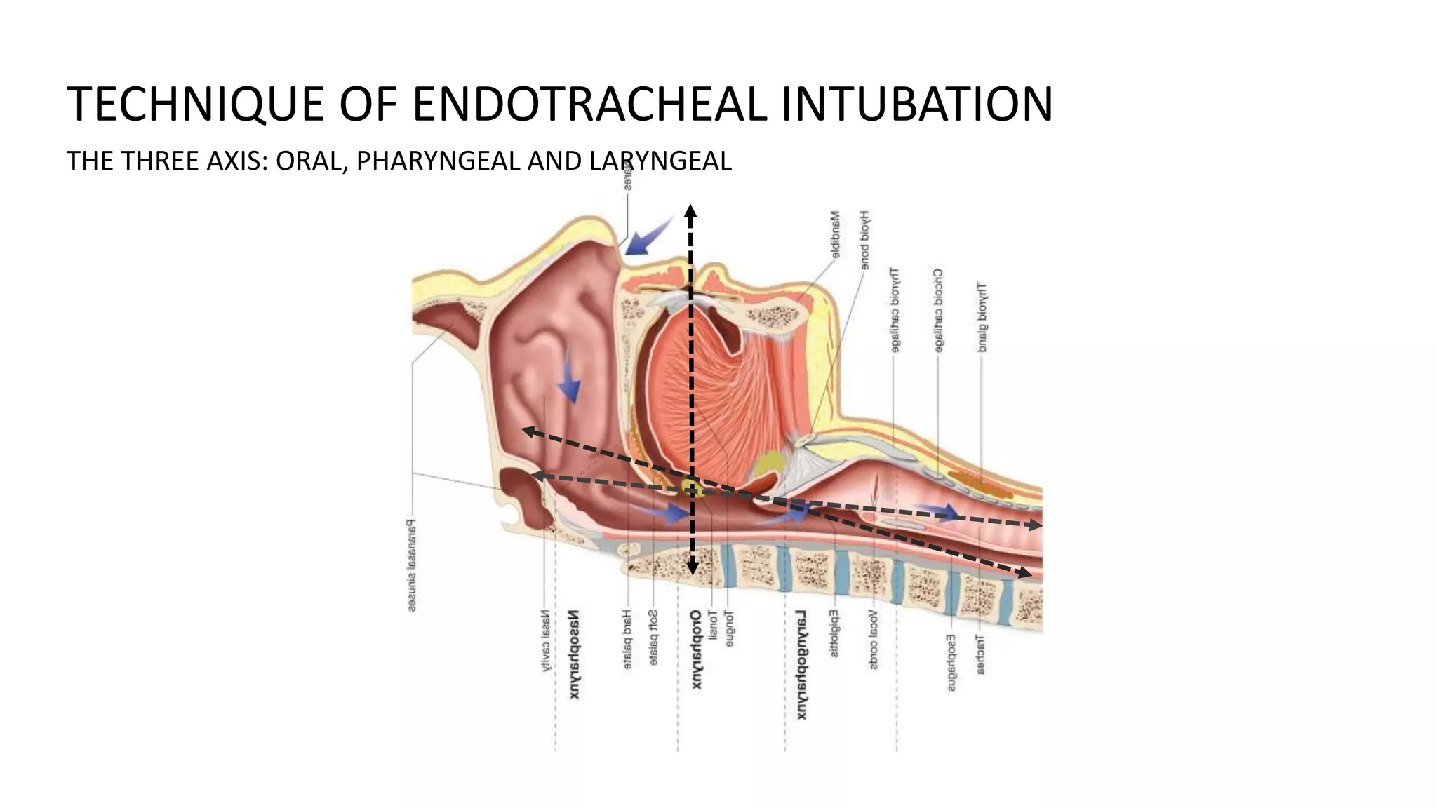 Endotracheal intubation | PPTX