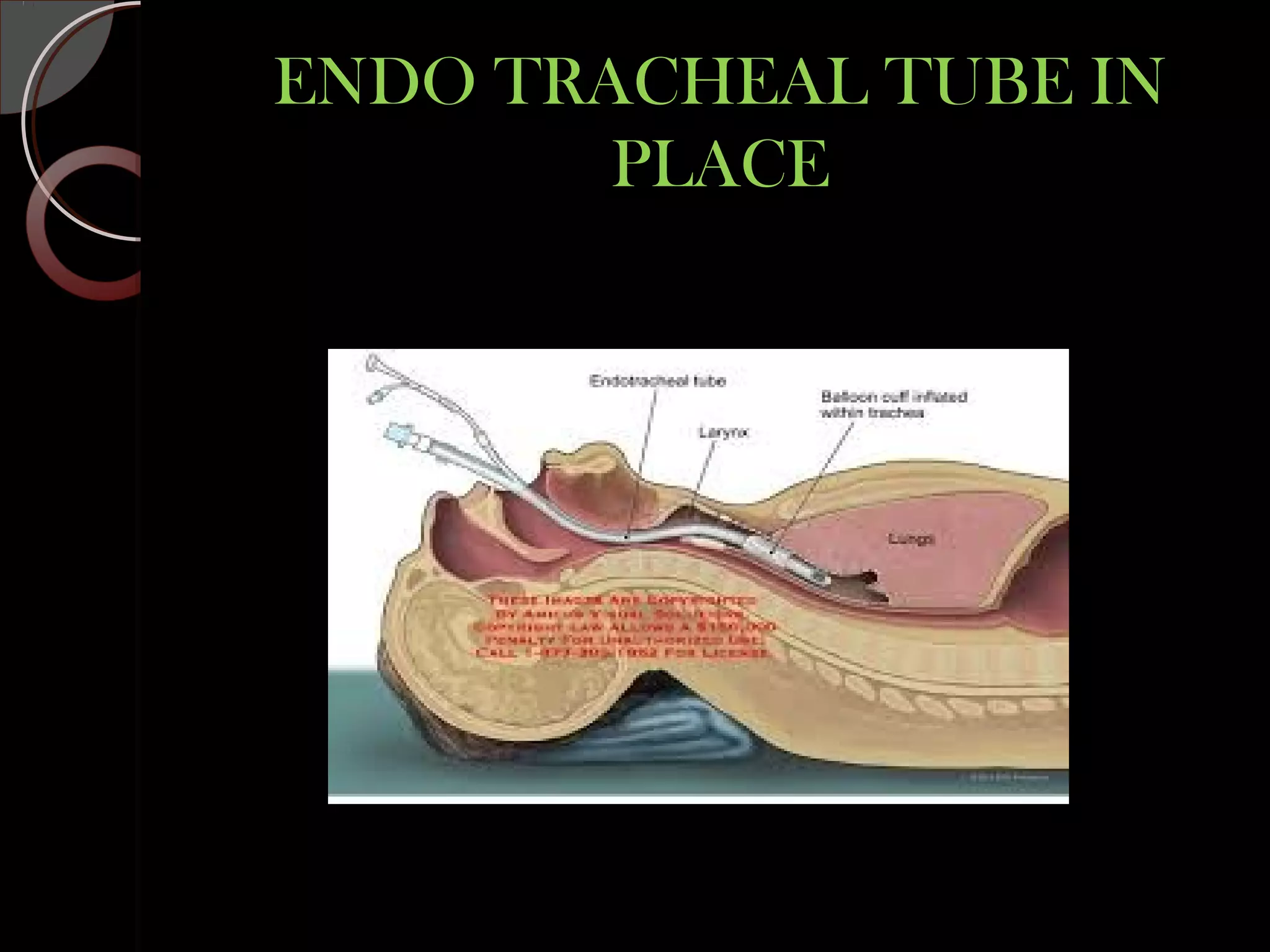 Endotracheal intubation | PPT