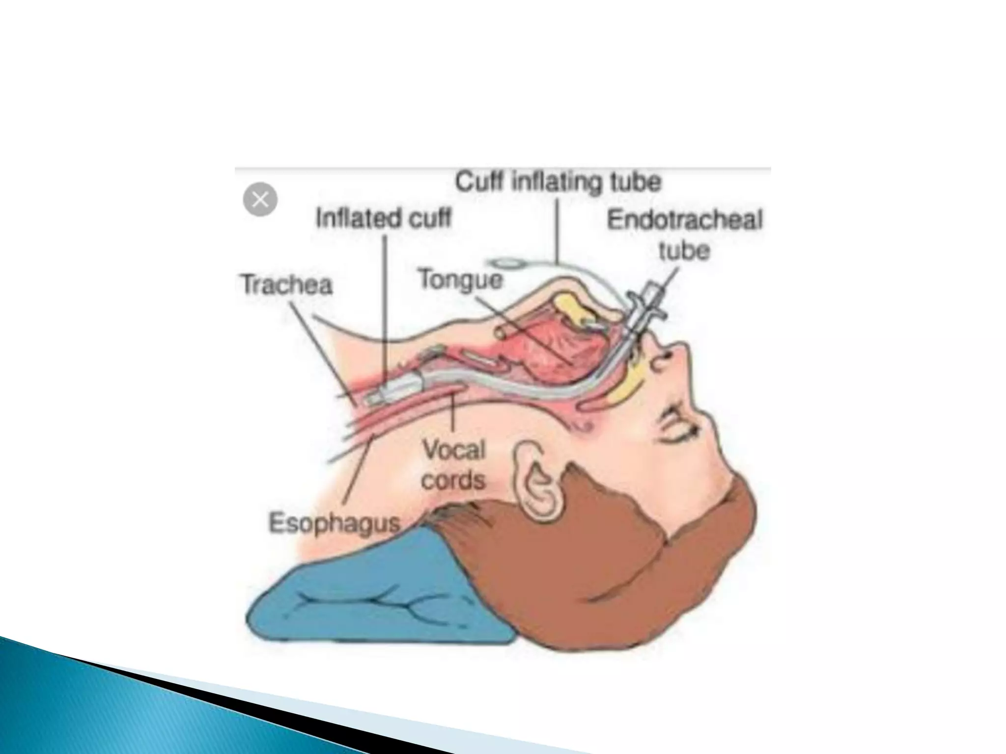 Endotracheal intubation | PPTX
