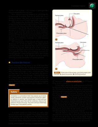 Endotracheal intubation | PDF