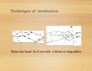 Endotracheal Intubation.pptx