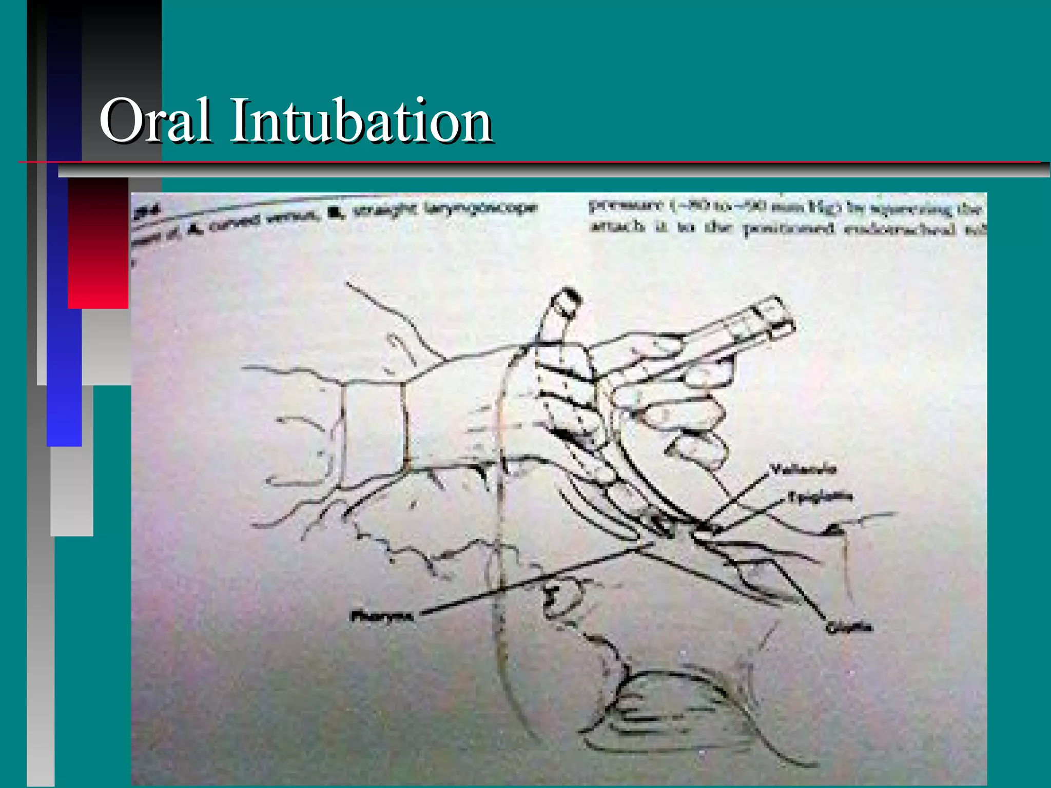 Endotracheal intubation extubation | PPT