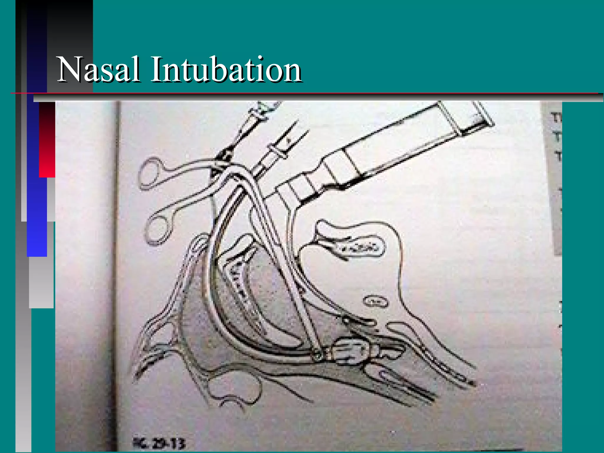Endotracheal intubation extubation | PPT