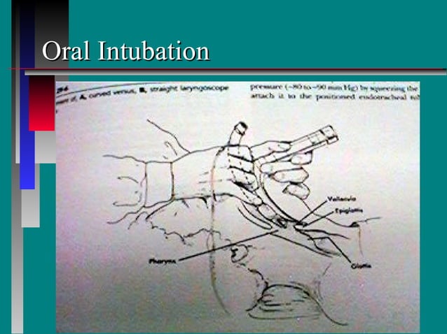 Endotracheal intubation extubation | PPT | Ear, Nose and Throat ...