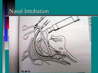 Endotracheal intubation extubation | PPT