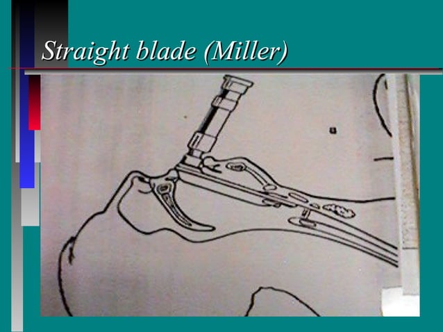 Endotracheal intubation extubation | PPT | Ear, Nose and Throat ...