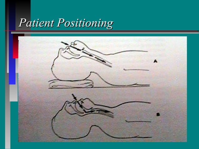 Endotracheal intubation extubation | PPT | Ear, Nose and Throat ...