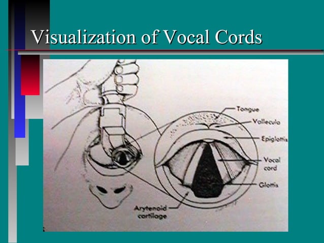 Endotracheal intubation extubation | PPT | Ear, Nose and Throat ...