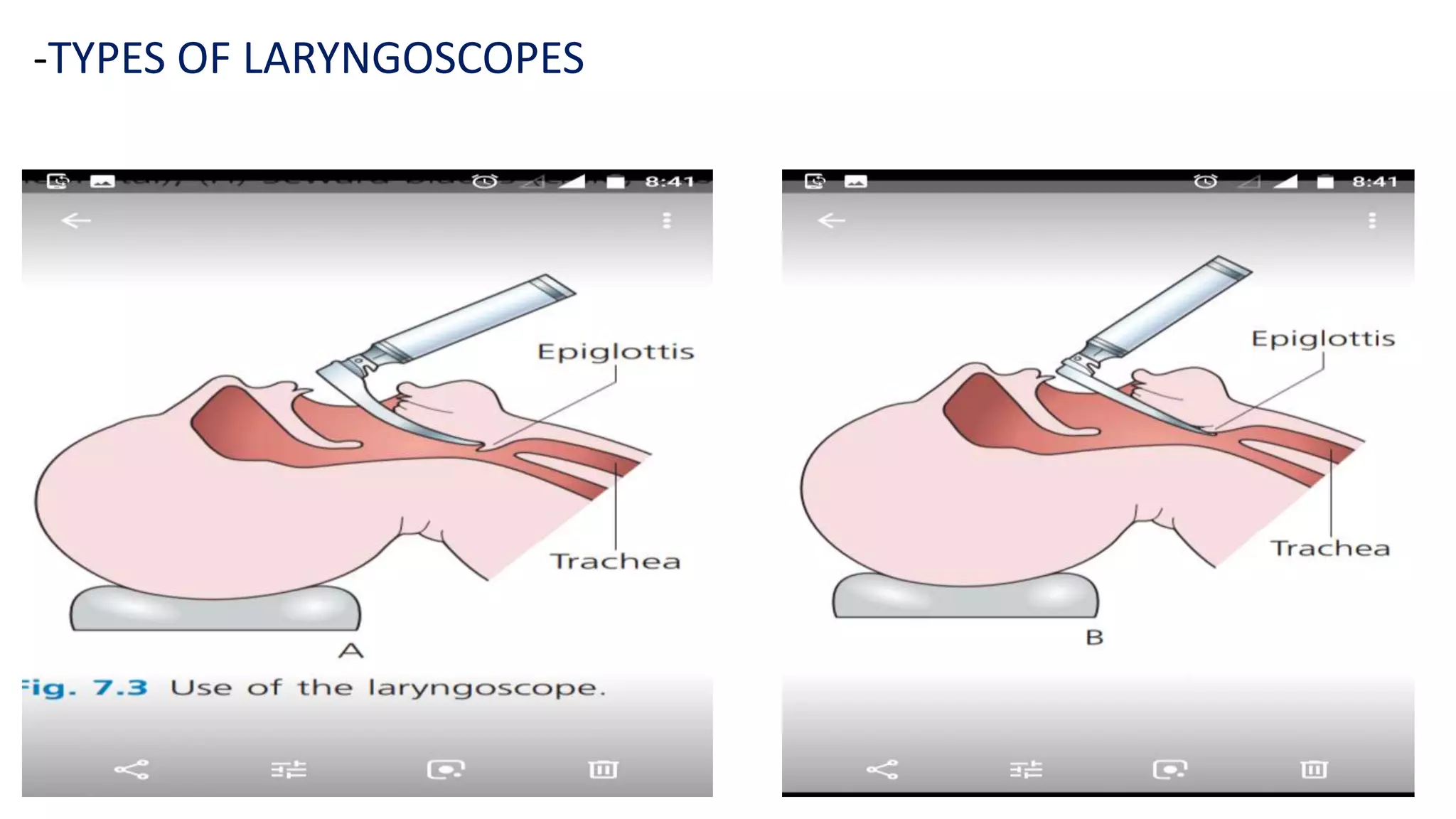Endotracheal intubation and laryngoscopy part 2 | PPTX