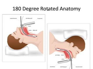 Endotracheal Intubation in Prone Position.pptx