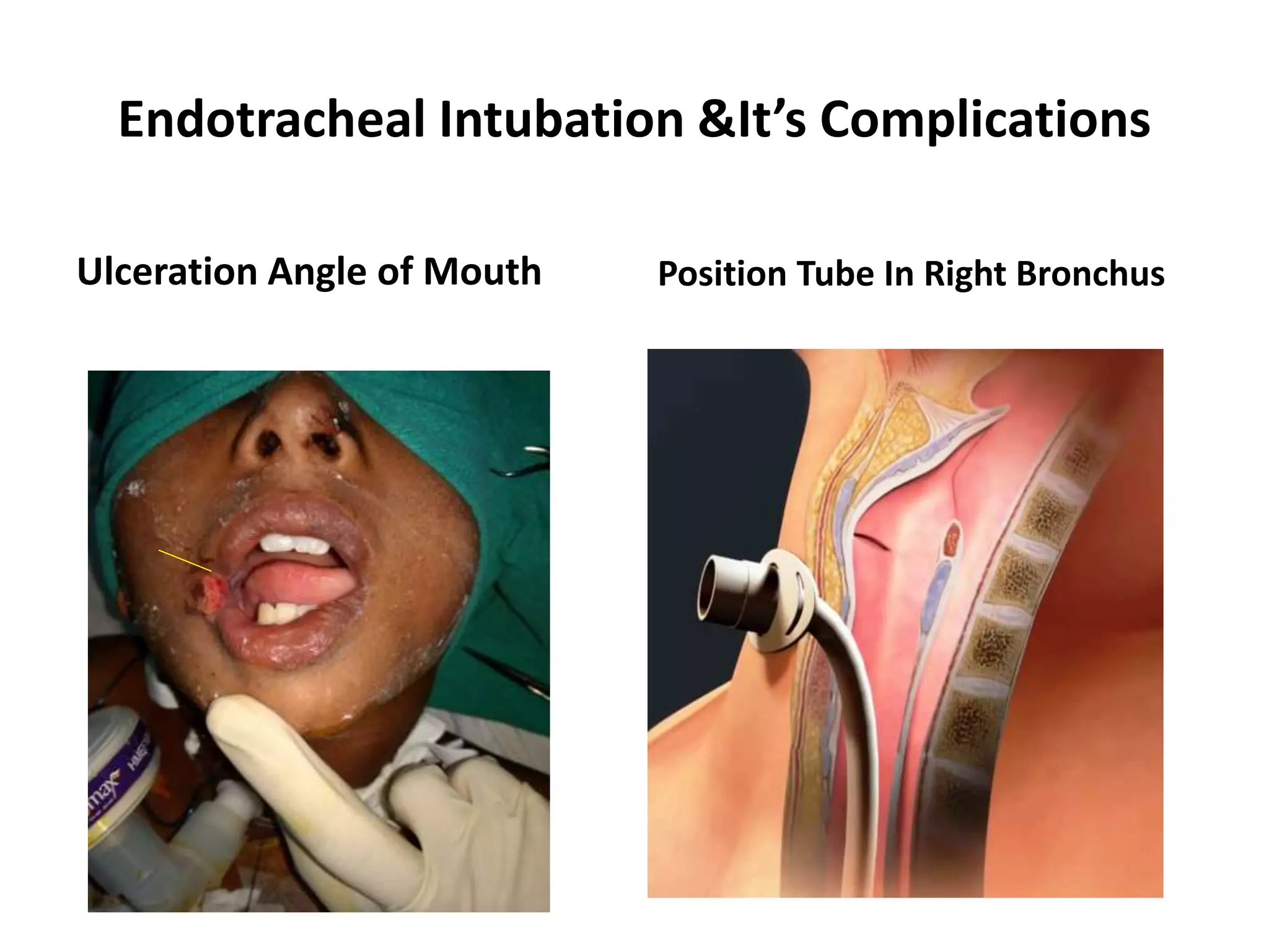 Endotracheal intubation & its complications | PPTX | First Aid | Injuries