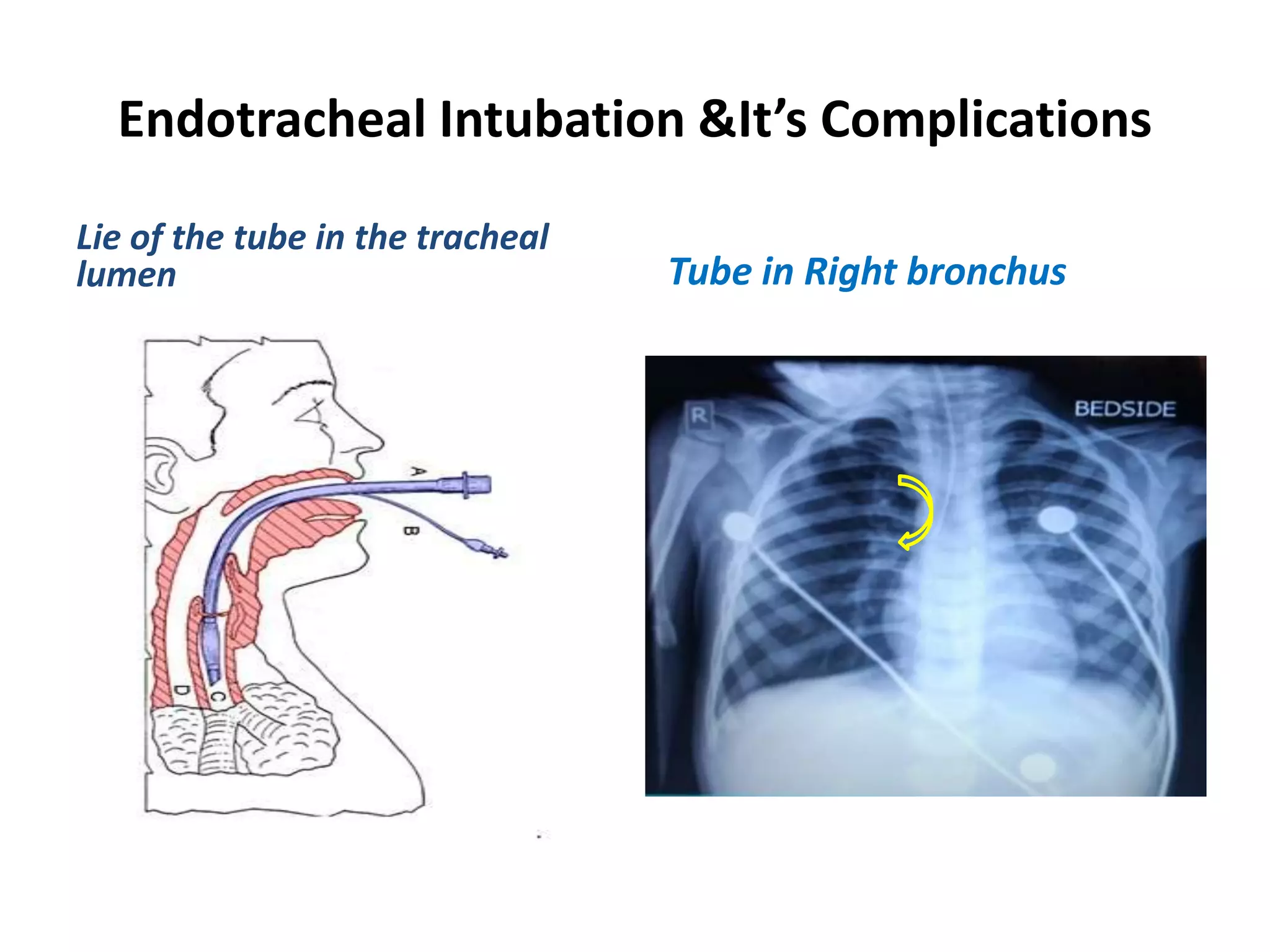 Endotracheal intubation & its complications | PPTX