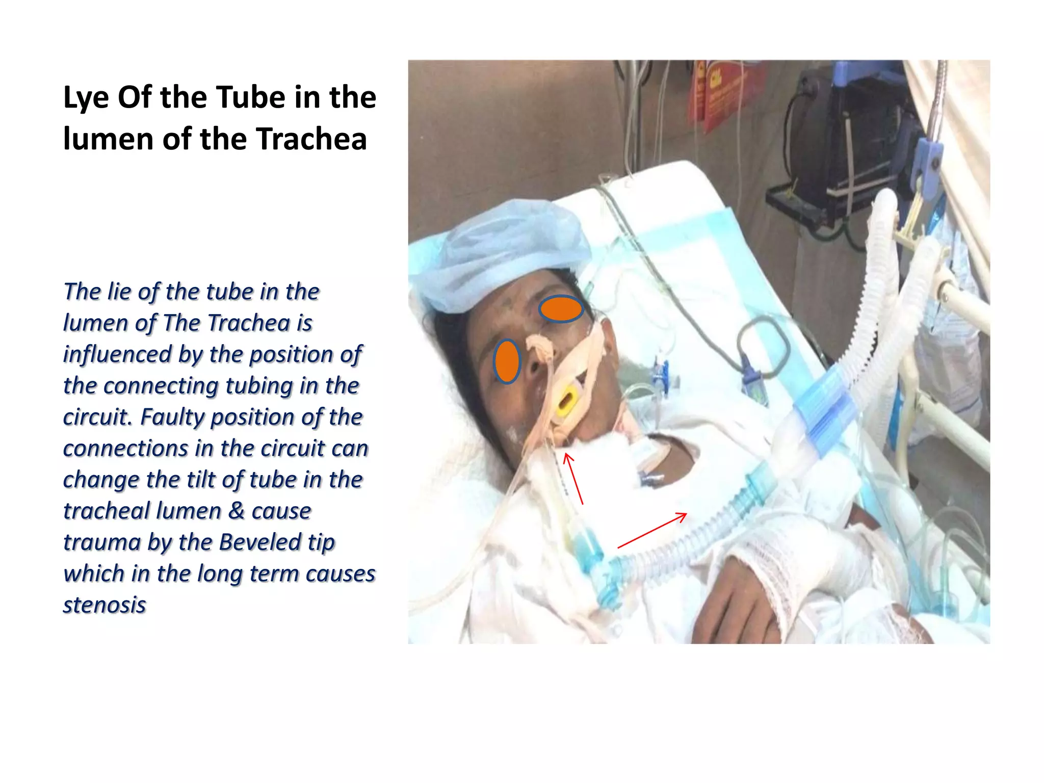 Endotracheal intubation & its complications | PPTX