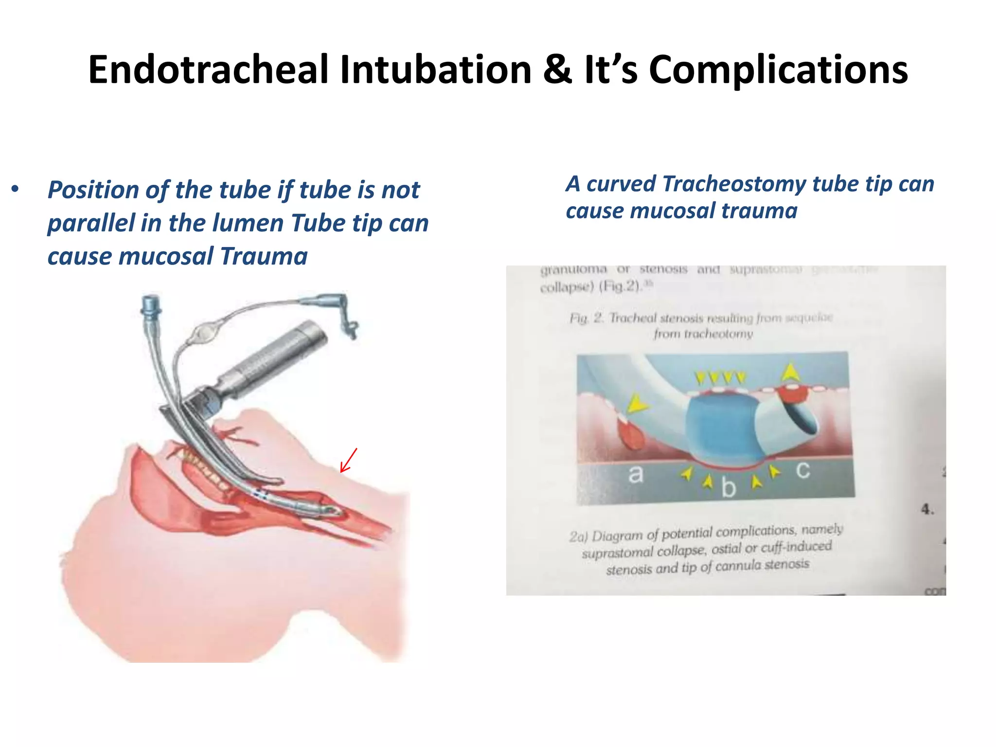 Endotracheal intubation & its complications | PPTX
