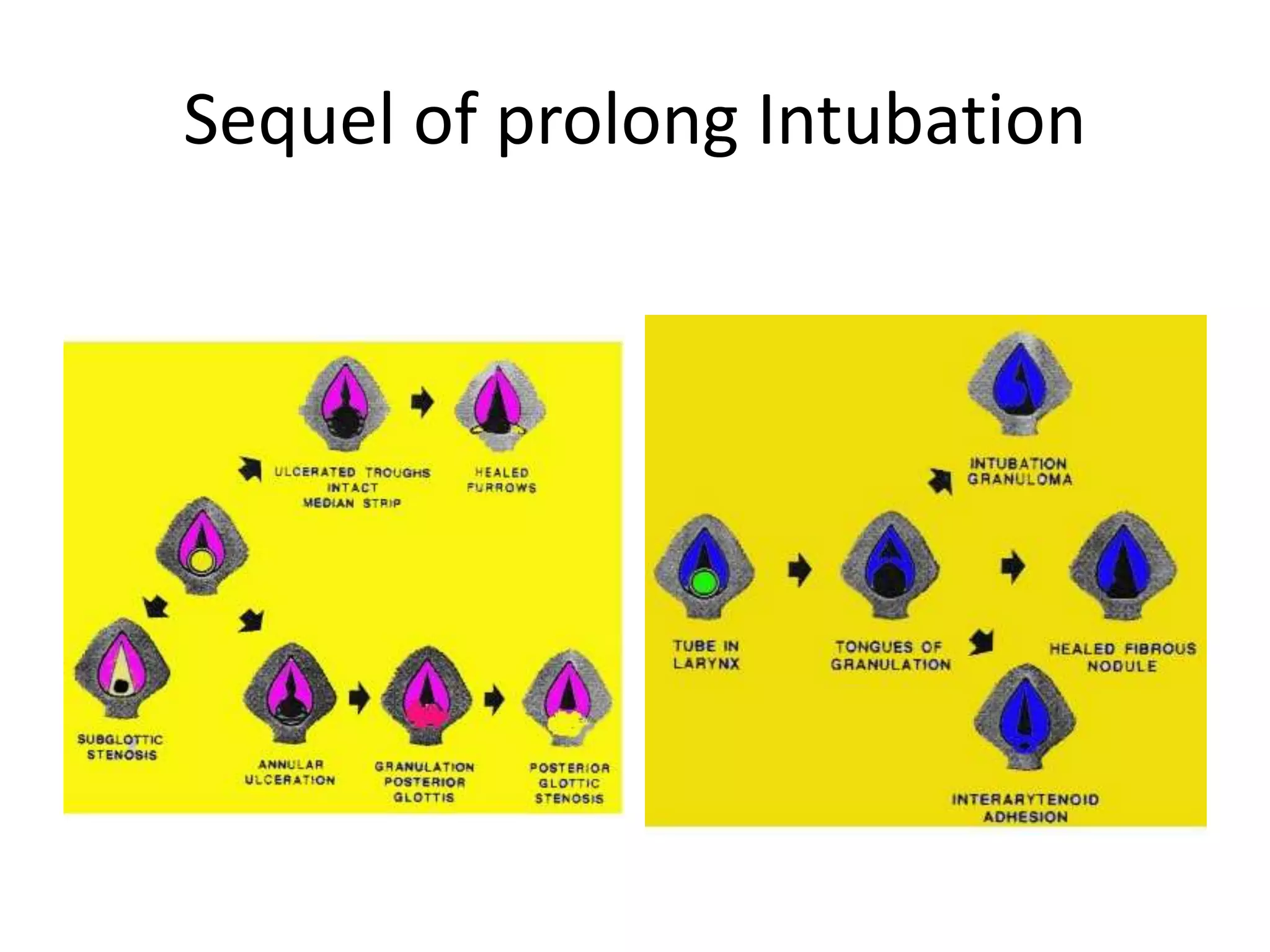 Endotracheal intubation & its complications | PPTX