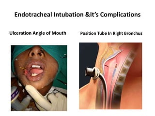Endotracheal intubation & its complications | PPTX