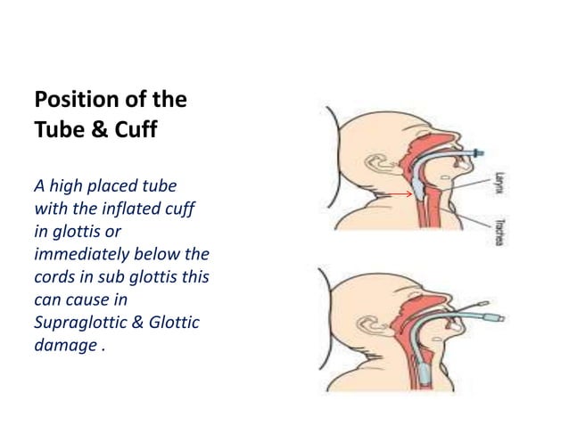 Endotracheal intubation & its complications | PPTX | First Aid | Injuries