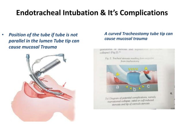 Endotracheal intubation & its complications | PPTX | First Aid | Injuries