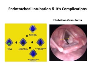 Endotracheal intubation & its complications | PPTX