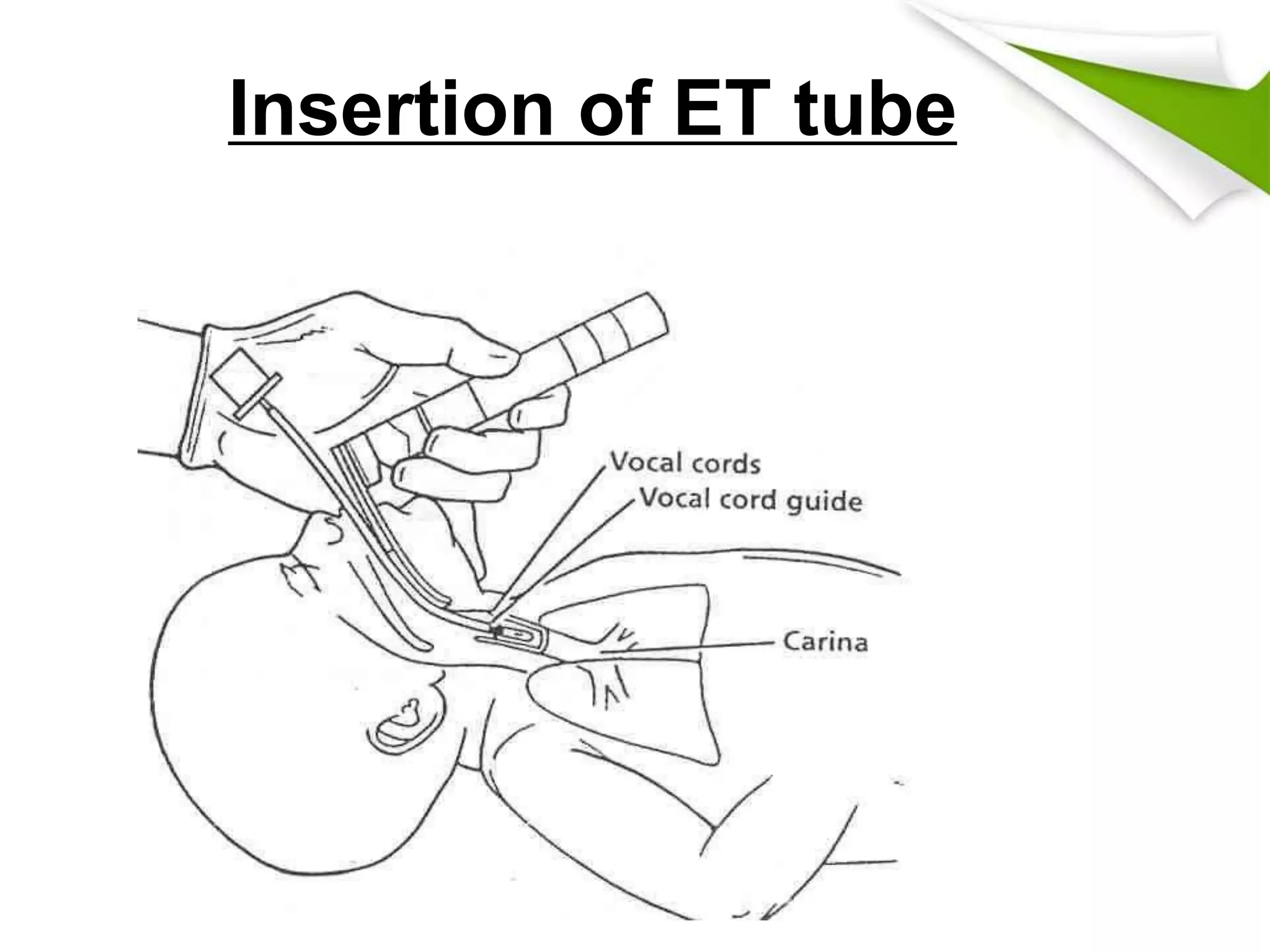 Endotracheal intubation nursing procedure | PPTX