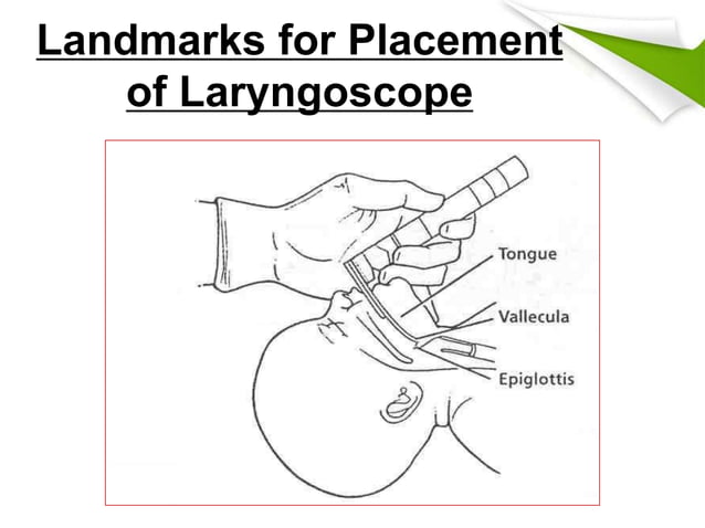 Endotracheal intubation nursing procedure | PPTX