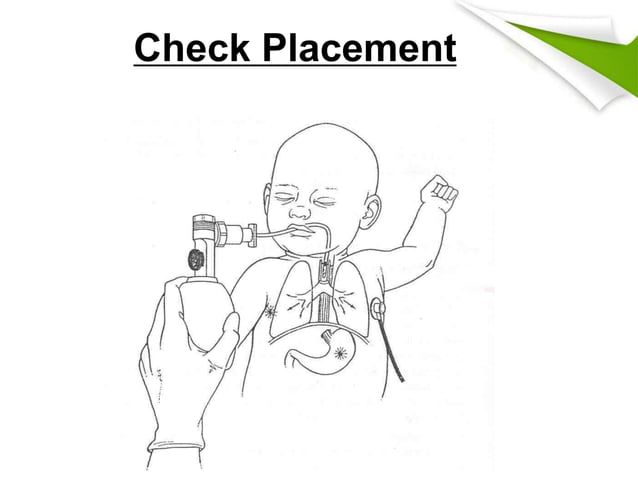 Endotracheal intubation nursing procedure | PPTX