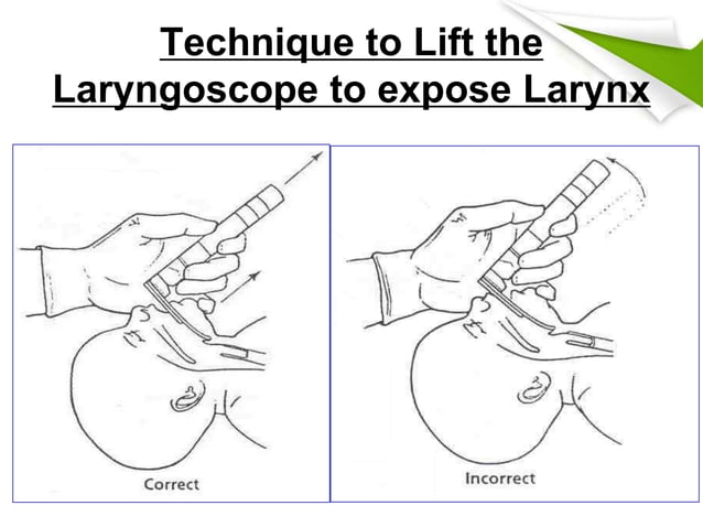 Endotracheal intubation nursing procedure | PPT