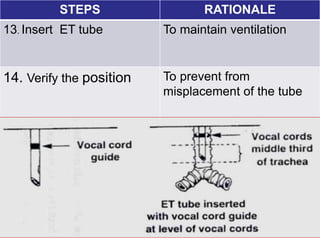 Endotracheal Intubation Vocal Cords