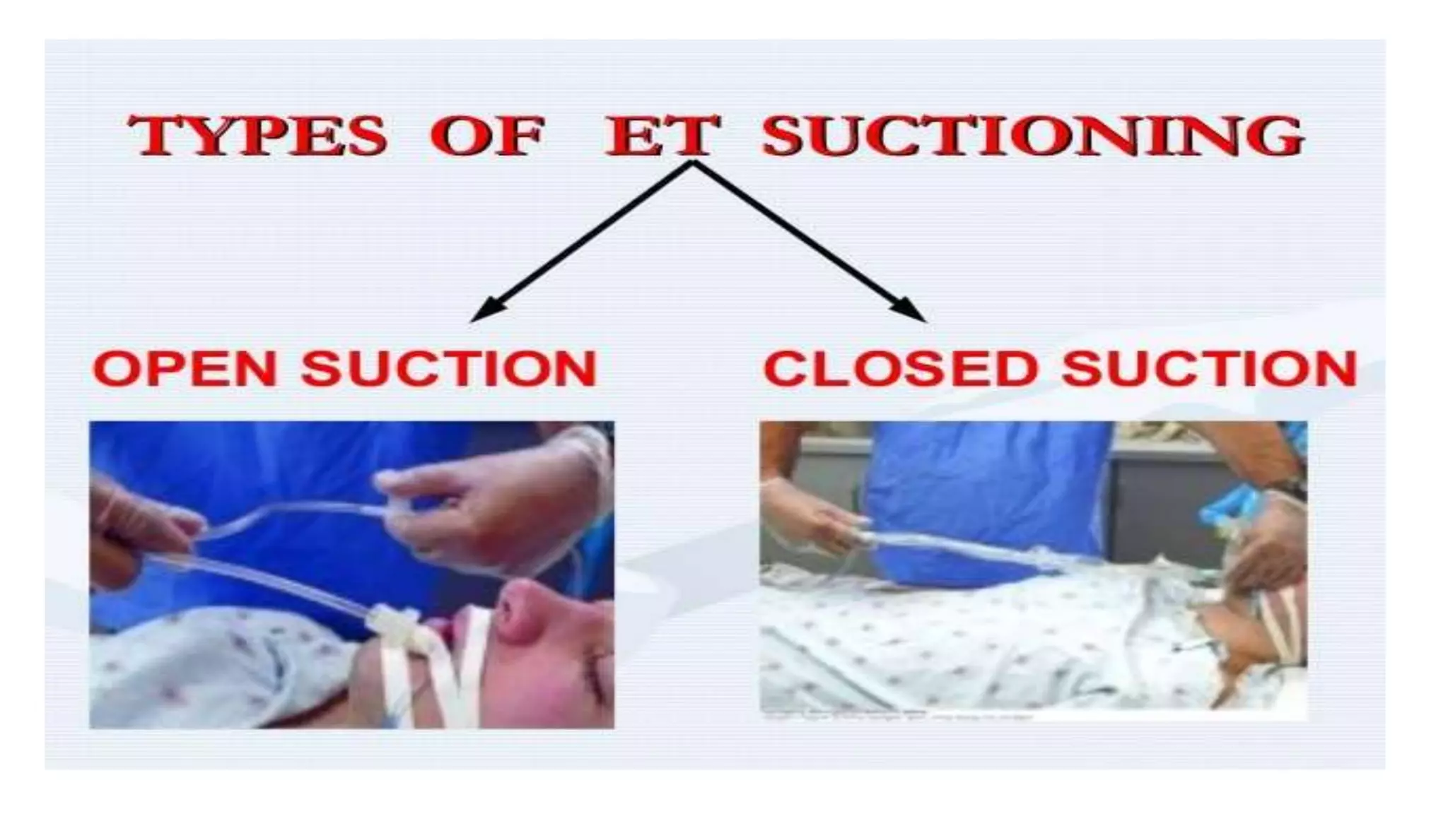 Endotracheal suctioning 2 | PPTX