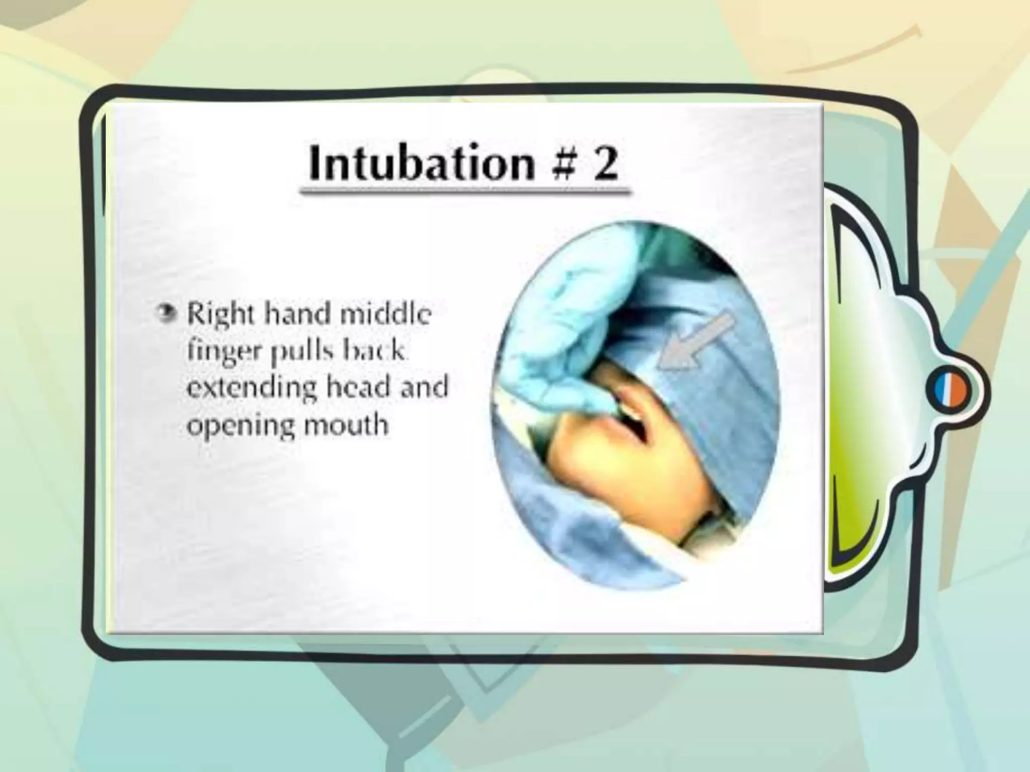 Endotracheal tube intubation | PPTX | Ear, Nose and Throat Conditions ...