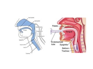 Endotracheal tubes | PPTX