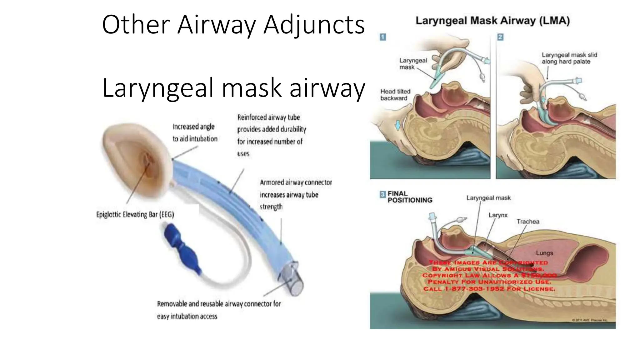 endotrachial intubation.pptx