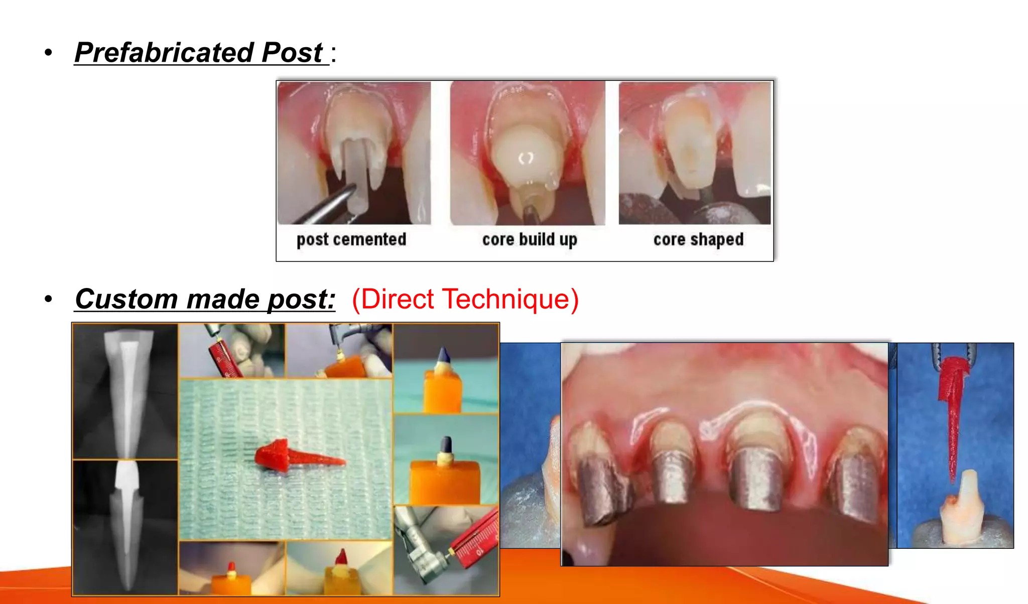 Rehabilitation of endodontically treated teeth : Post & Core | PPTX