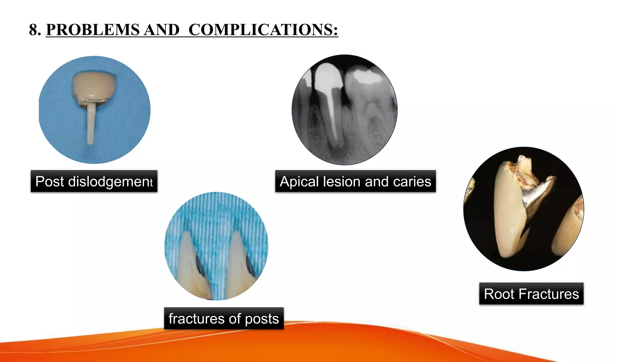 Rehabilitation of endodontically treated teeth : Post & Core | PPT