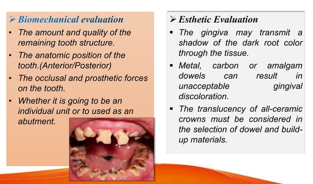 Rehabilitation of endodontically treated teeth : Post & Core | PPTX ...