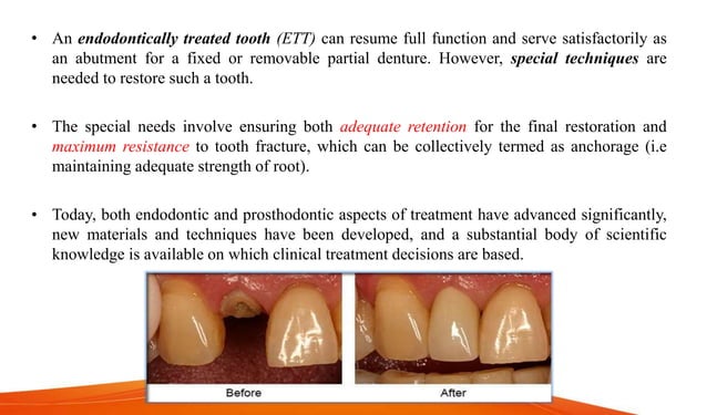 Rehabilitation of endodontically treated teeth : Post & Core | PPTX ...