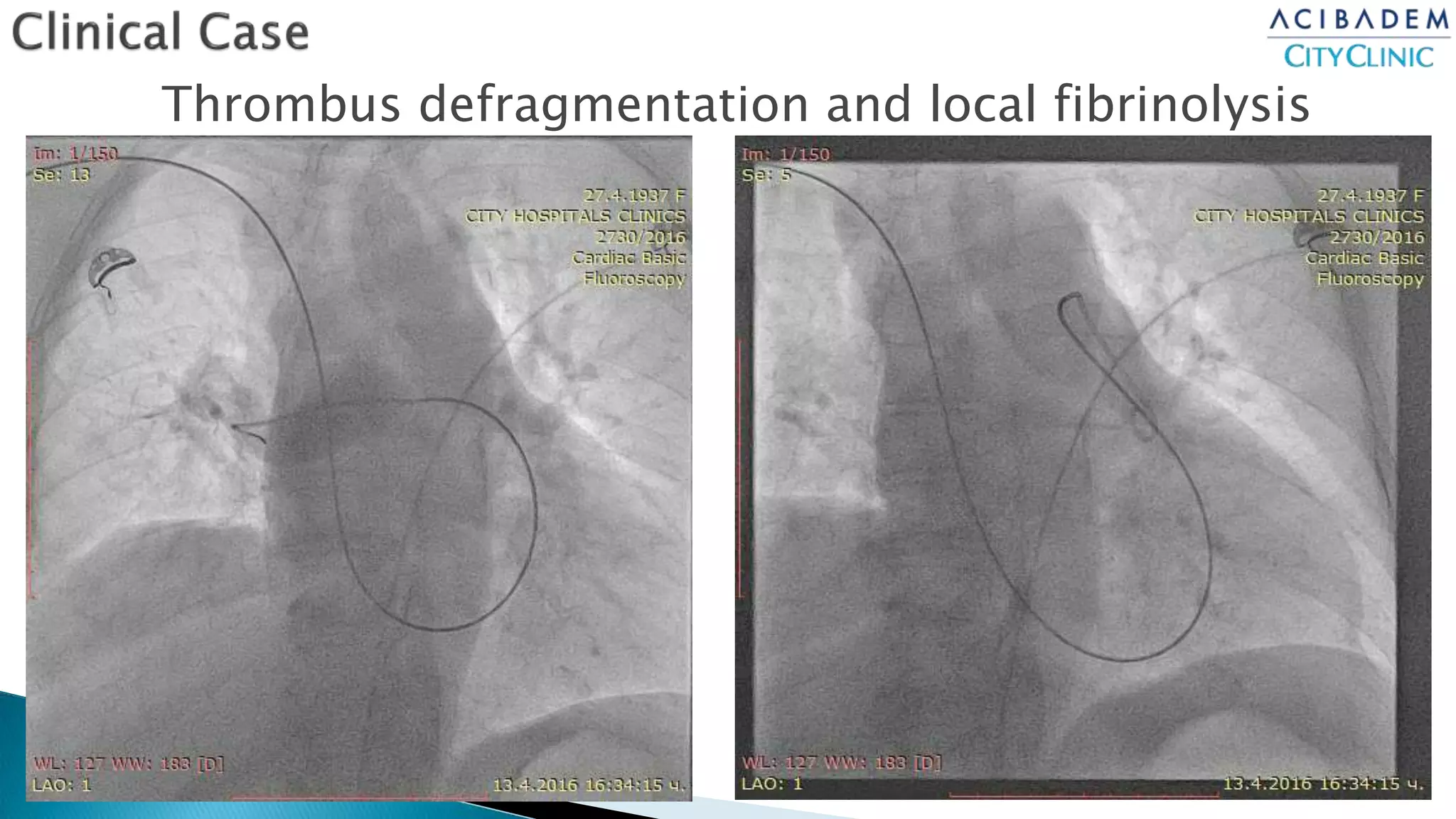 Endovascular and surgical treatment of pulmonary embolism 26.11.17
